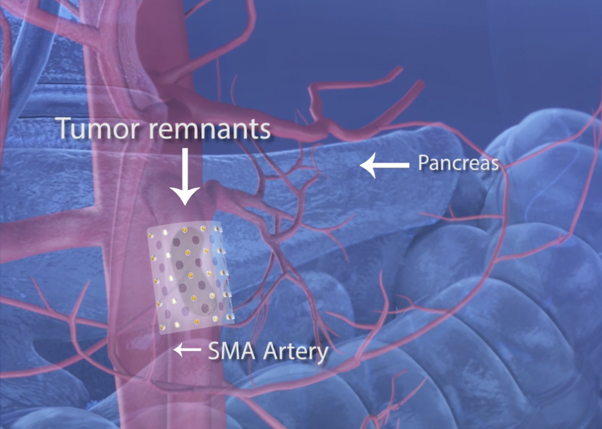 CivaSheet® - CivaTech Oncology